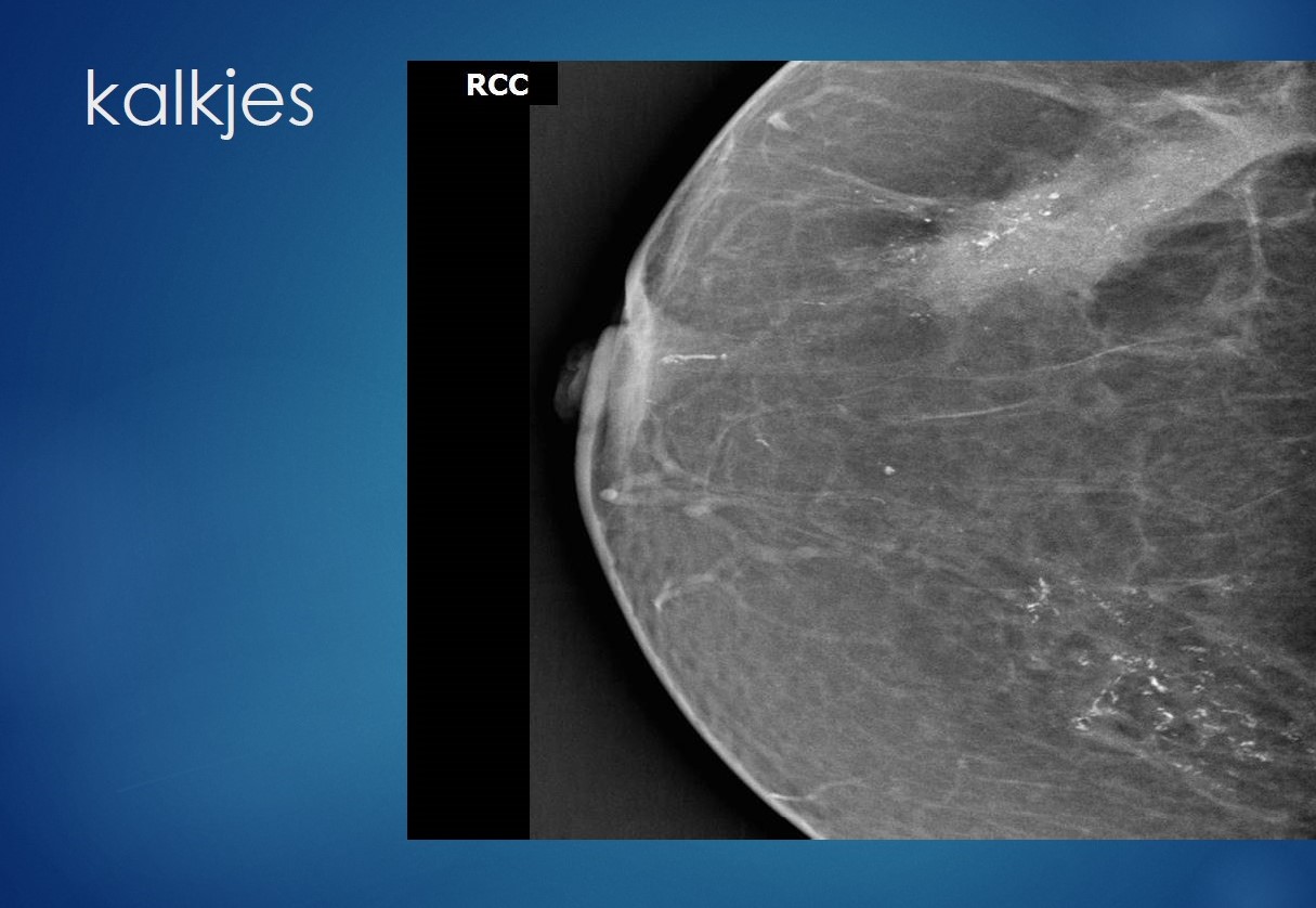 Lezing Femme Zijlstra: 'Hoe dicht is jouw borstweefsel?' | MMV